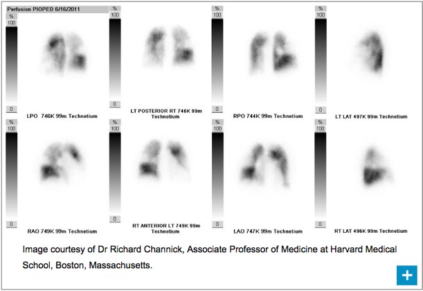 CTEPH | V/Q scan information in CTEPH